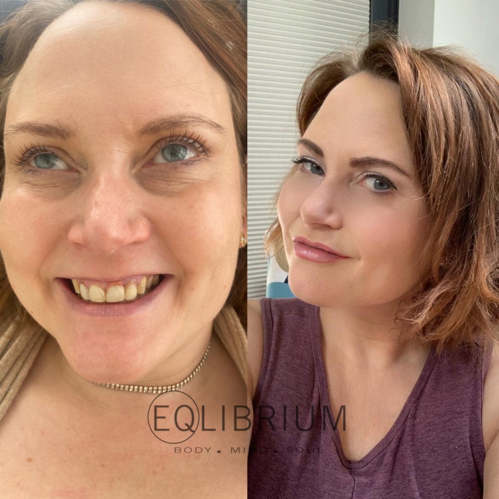 Full Facial Transformations - EQLibrium