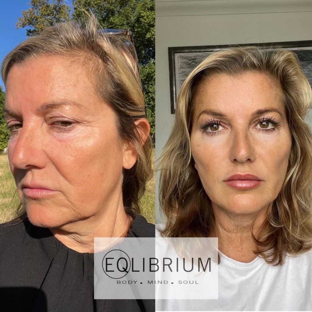 Gentle PDO Thread Recovery and Aftercare - EQLibrium